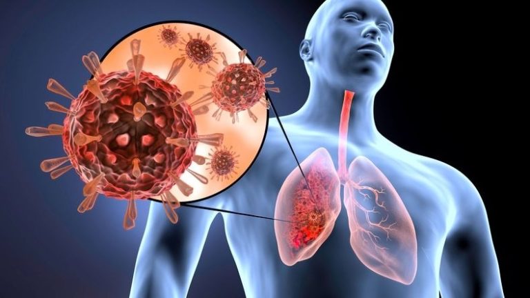 Lung infection: a guide to this disease