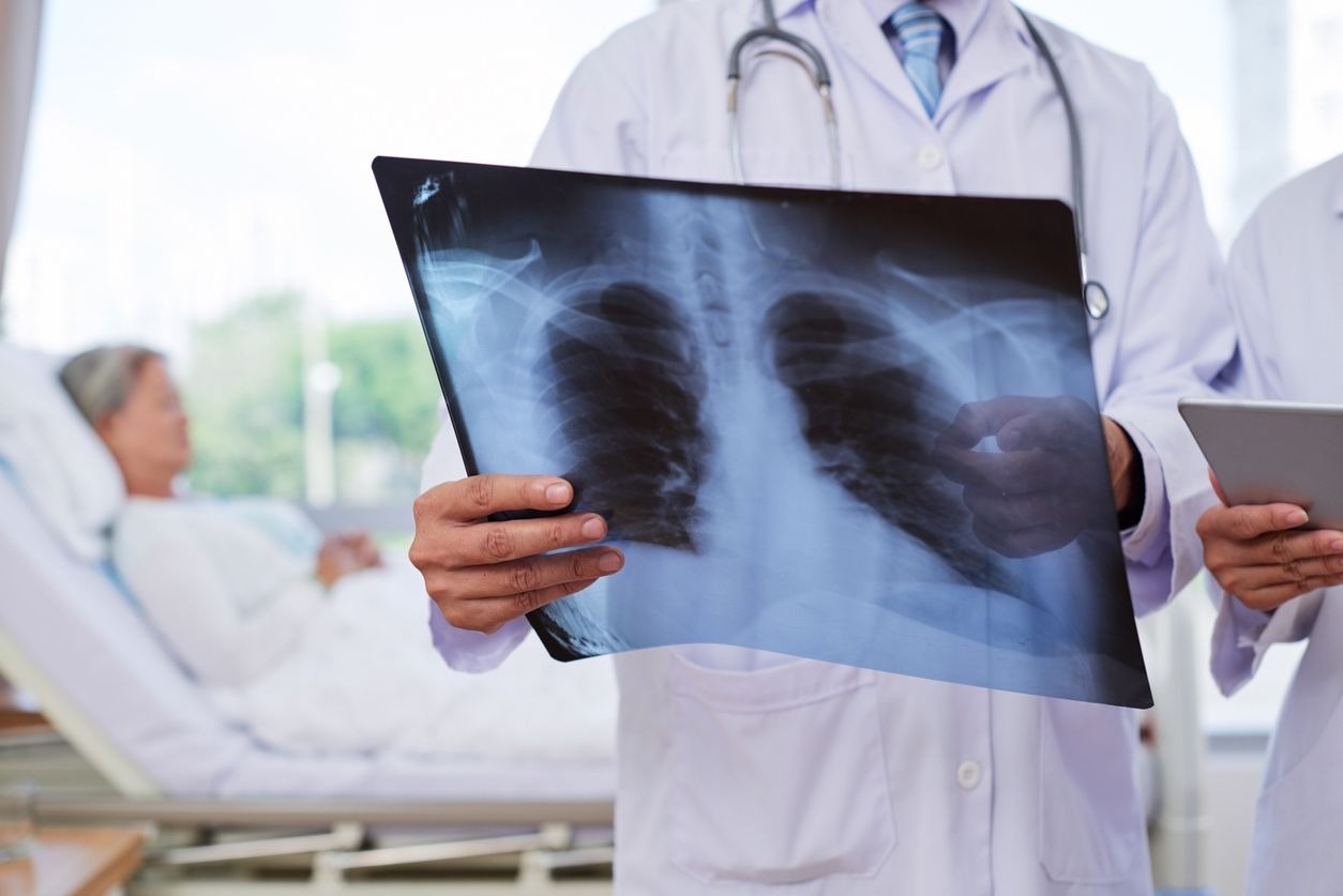 Pneumonia: guide to this acute respiratory infection